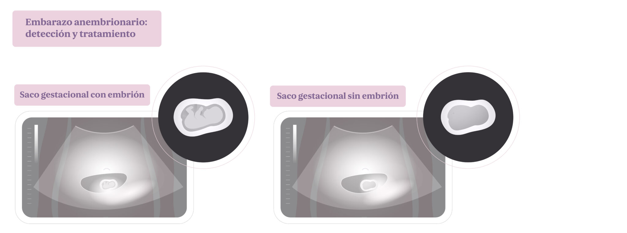 Embarazo anembrionario: detección y tratamiento - Next Fertility
