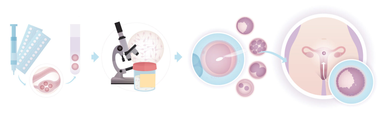Fecundación in Vitro (FIV): ¿qué es y cómo es el embarazo? - Next Fertility
